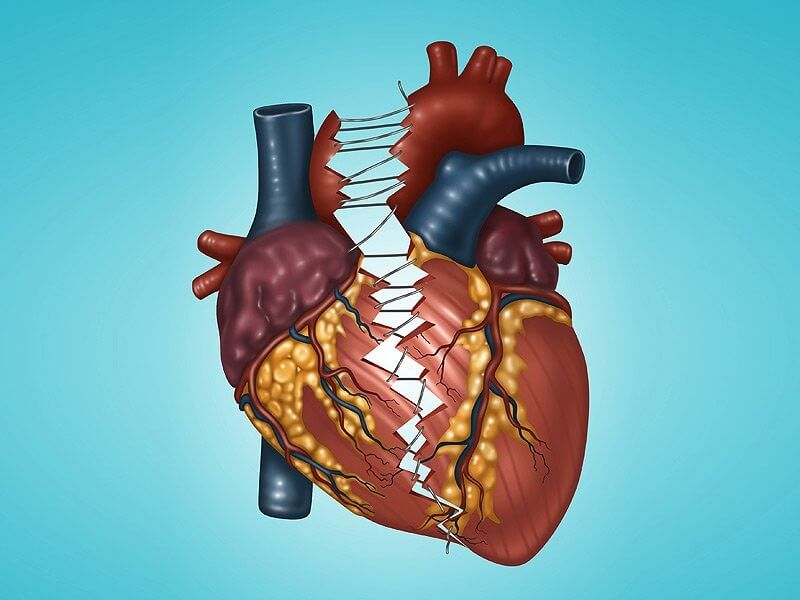 Broken Heart Syndrome: Symptoms, Causes, Treatments