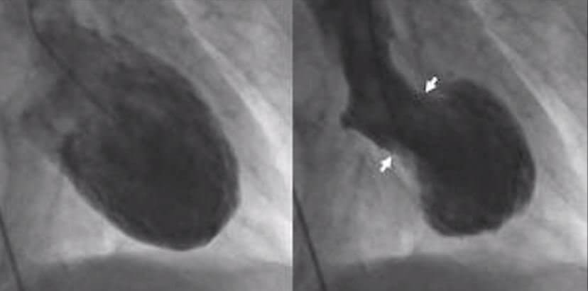 Broken Heart Syndrome: Symptoms, Causes, Treatments Broken Heart Syndrome: Symptoms, Causes, Treatments