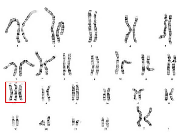 Patau Syndrome: Symptoms, Causes, Treatment | Its Psychology